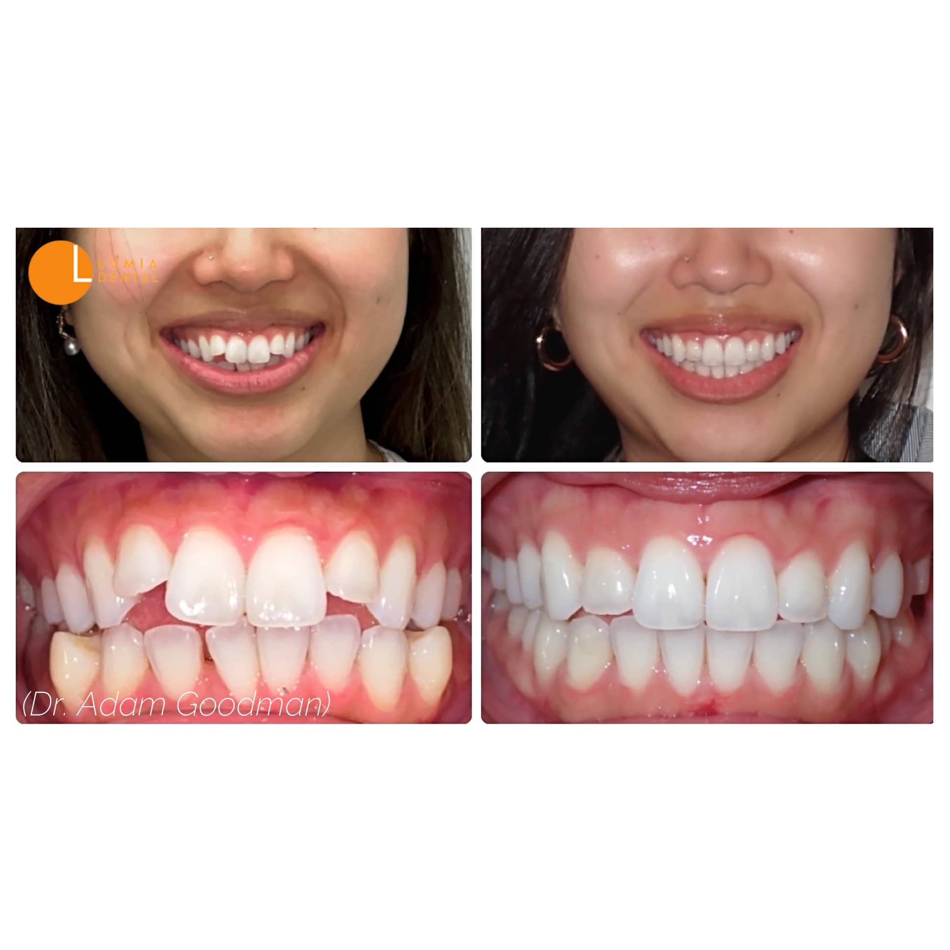 Before & after photos of our satisfied patients - Smile gallery from ...