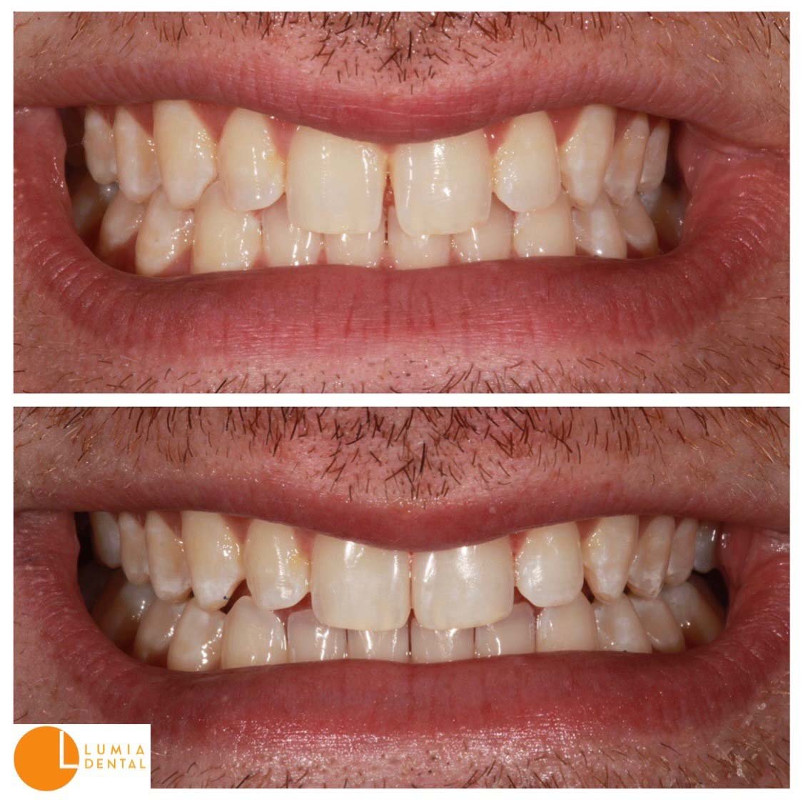 Before & after photos of our satisfied patients - Smile gallery from ...