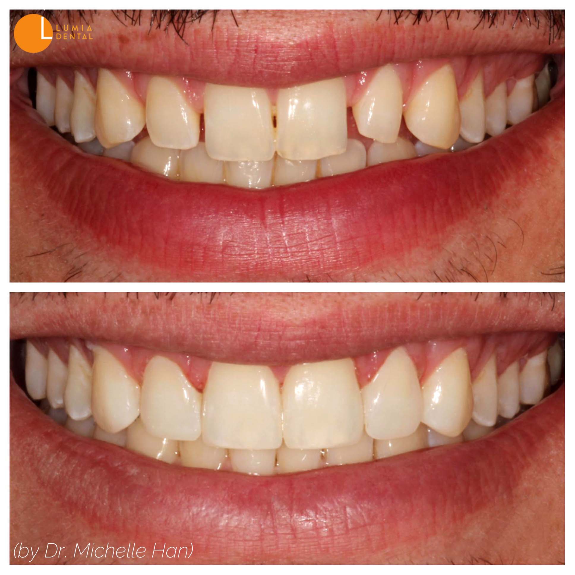 Before & after photos of our satisfied patients - Smile gallery from ...