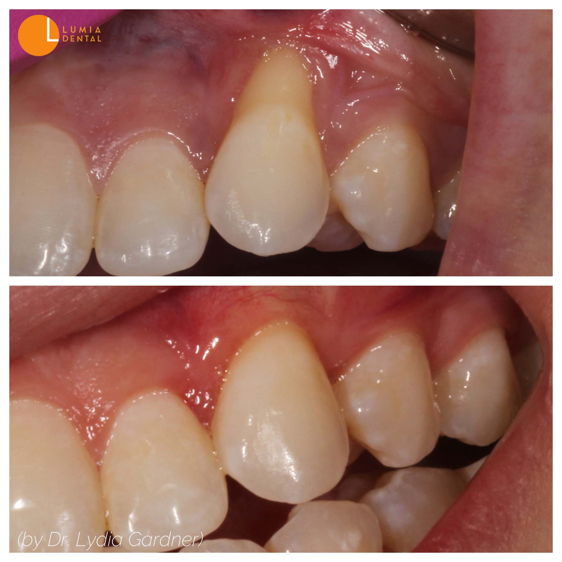Before & after photos of our satisfied patients - Smile gallery from ...