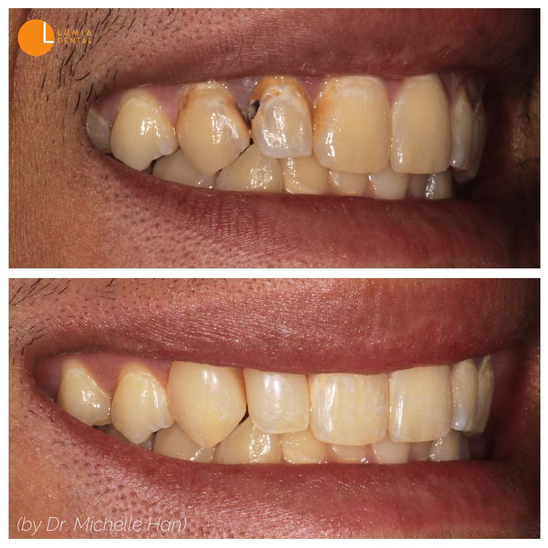 Before & after photos of our satisfied patients - Smile gallery from ...