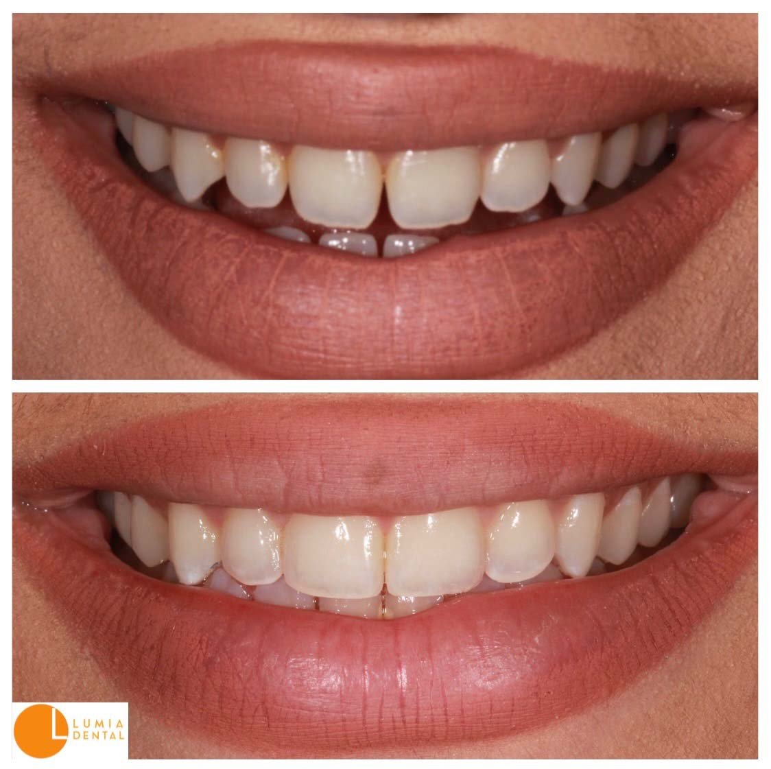 Before & after photos of our satisfied patients - Smile gallery from ...