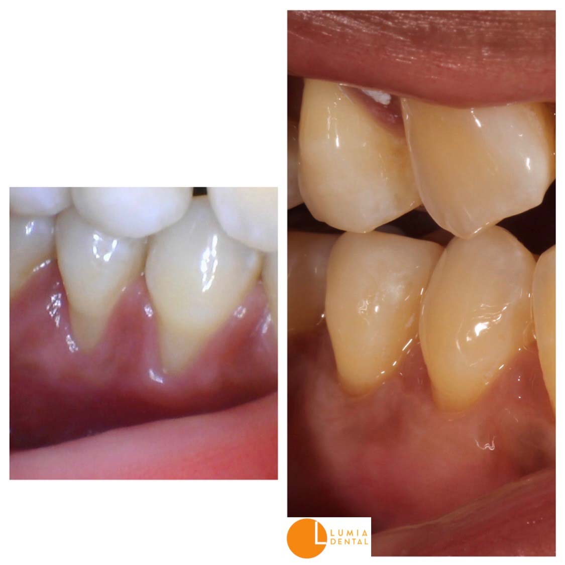 Before & after photos of our satisfied patients - Smile gallery from ...