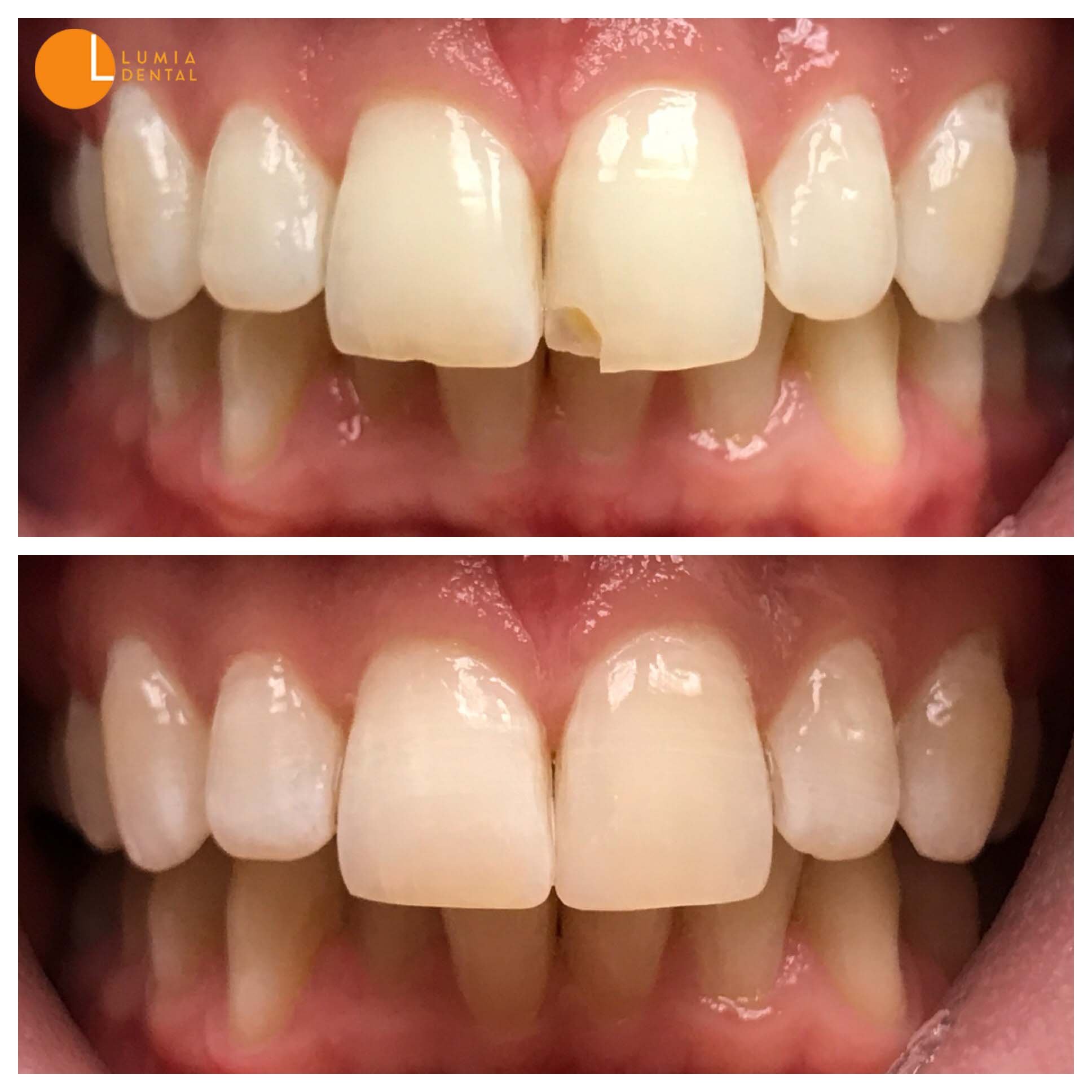 Before & after photos of our satisfied patients - Smile gallery from ...