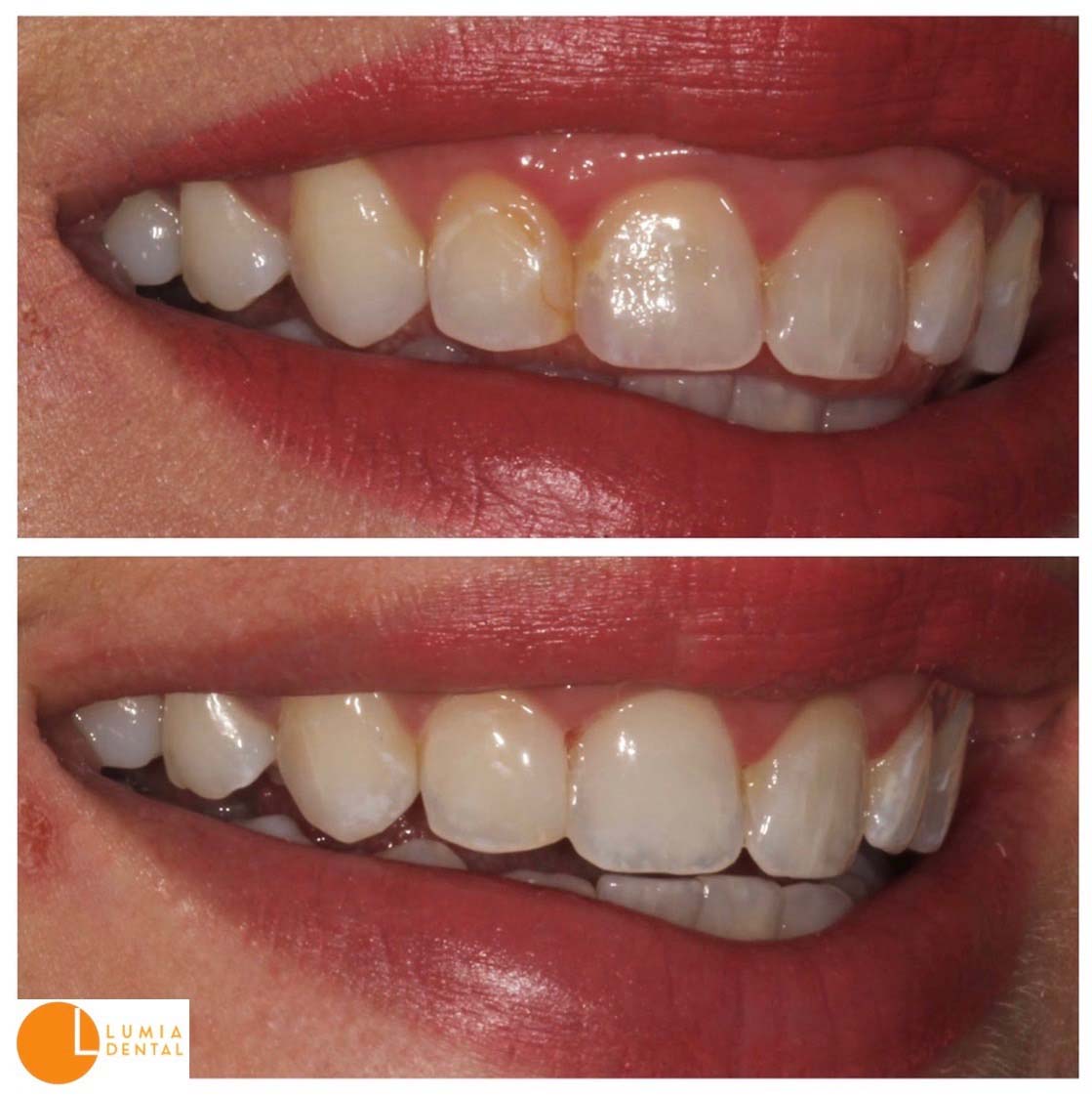 Before & after photos of our satisfied patients - Smile gallery from ...