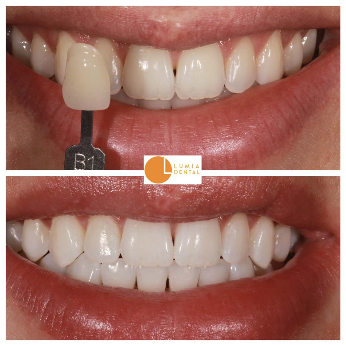 Before & after photos of our satisfied patients - Smile gallery from ...