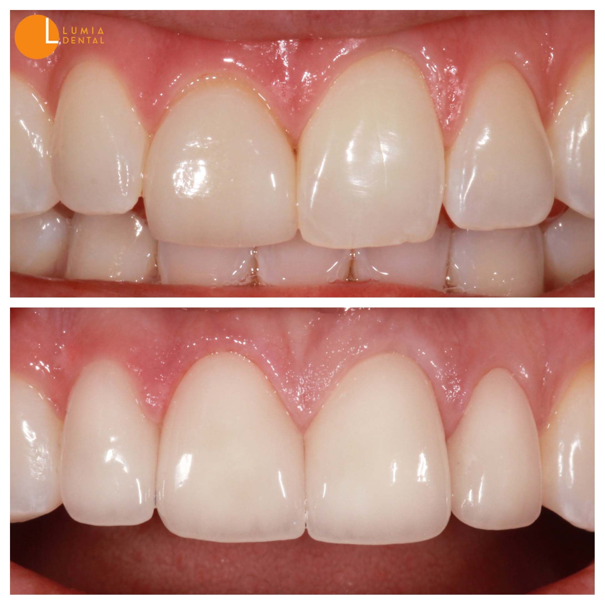 Before & after photos of our satisfied patients - Smile gallery from ...